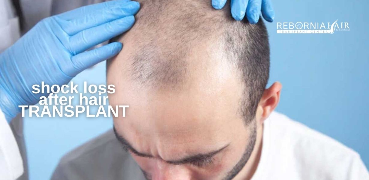What Is ‘Shock Loss’ After a Hair Transplant? | Rebornia Hair